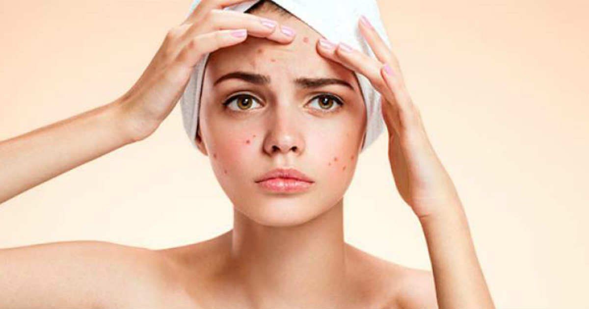 Como Remover as Manchas de Acne do Rosto! - Plano Criativo